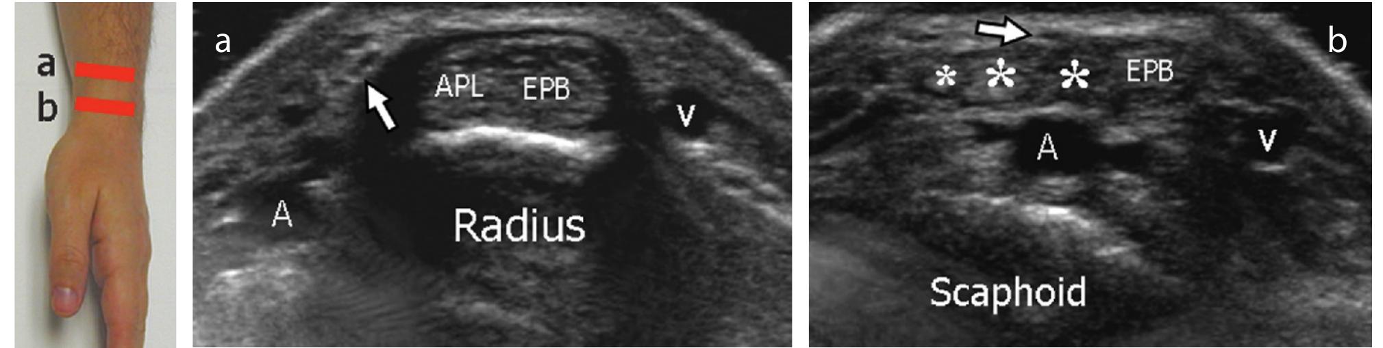 Legend a radial artery; apl abductor pollicis longus tendon;