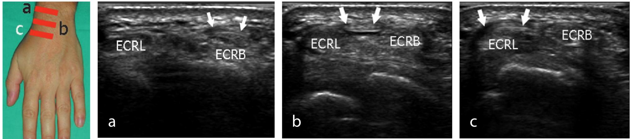 Legend arrows extensor pollicis longus tendon; ecrb extensor