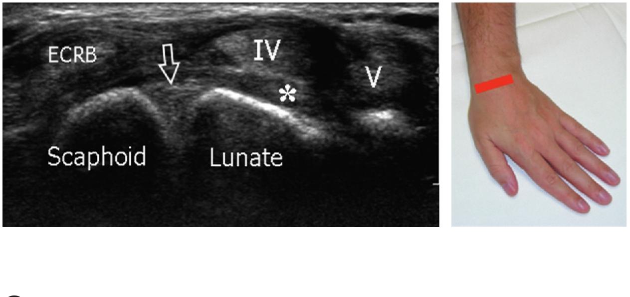 7. scapholunate ligament legend arrows extensor carpi