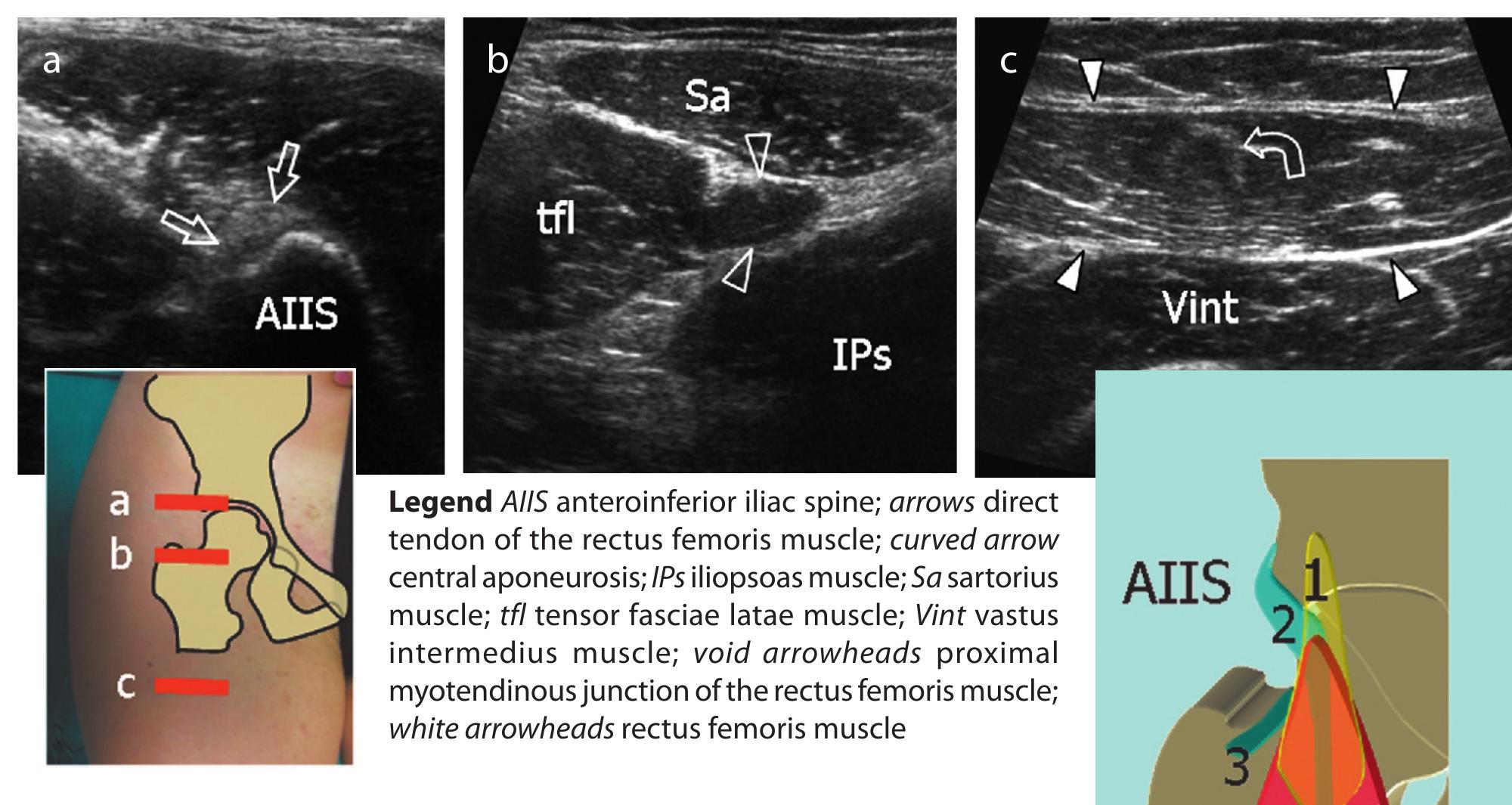 In the proximal rectus femoris muscle, the central
