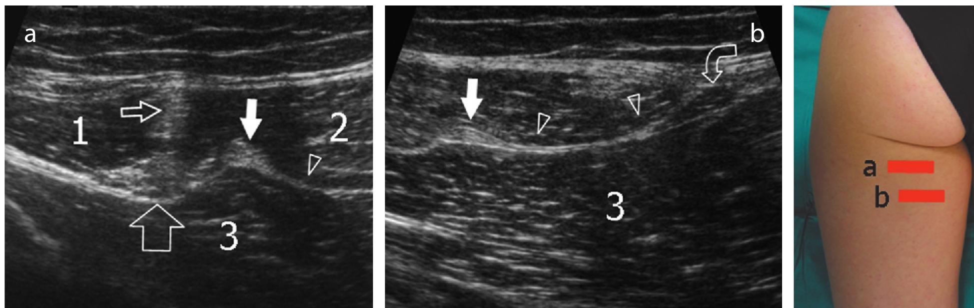 Legend large void arrow sciatic nerve; narrow void arrow