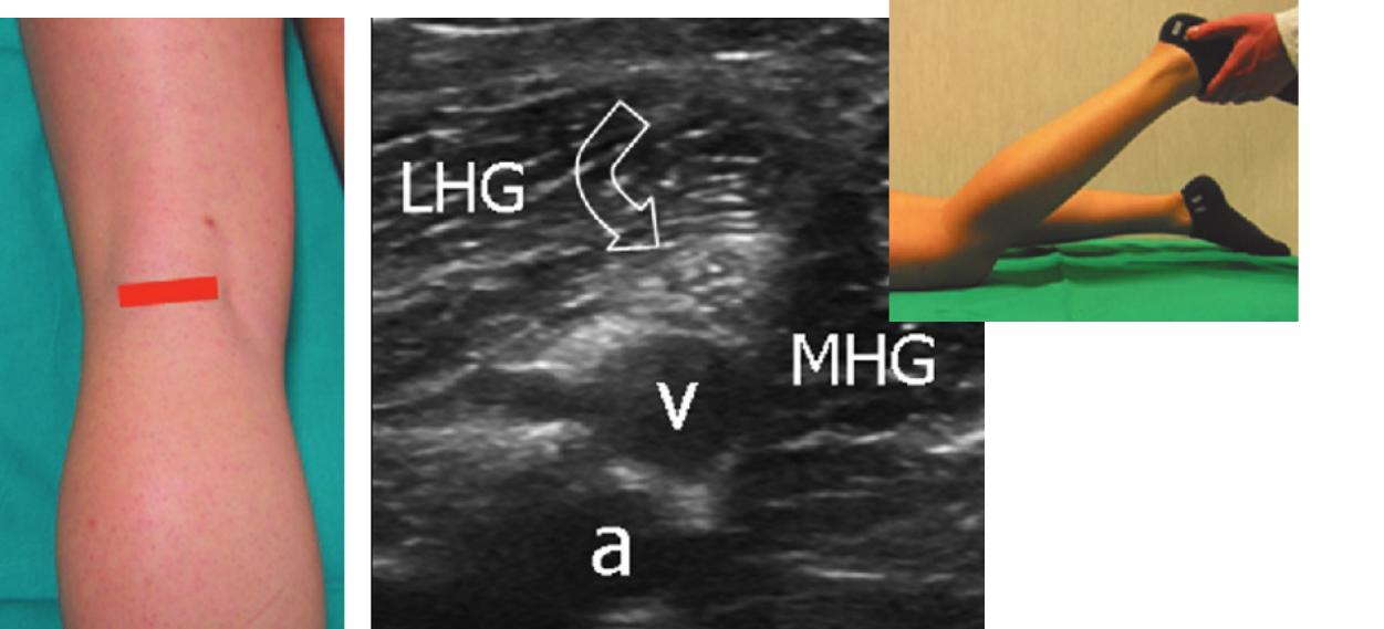 Legend a popliteal artery; curved arrow tibial nerve; f