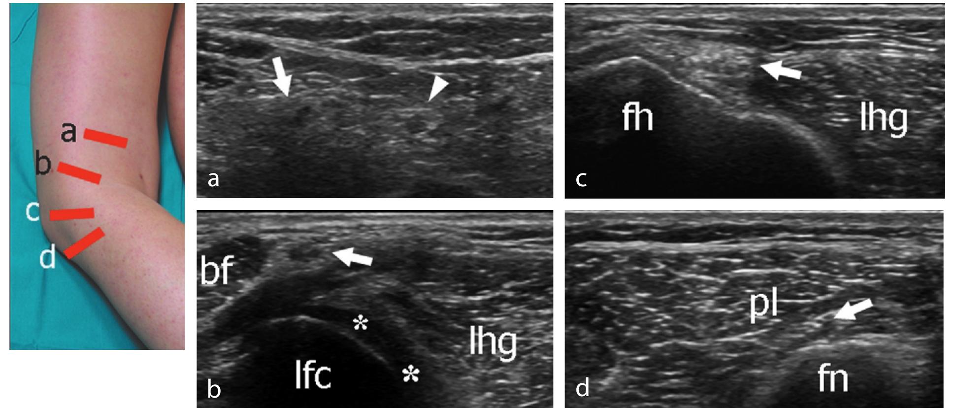 Legend arrow peroneal nerve; arrowhead tibial nerve;