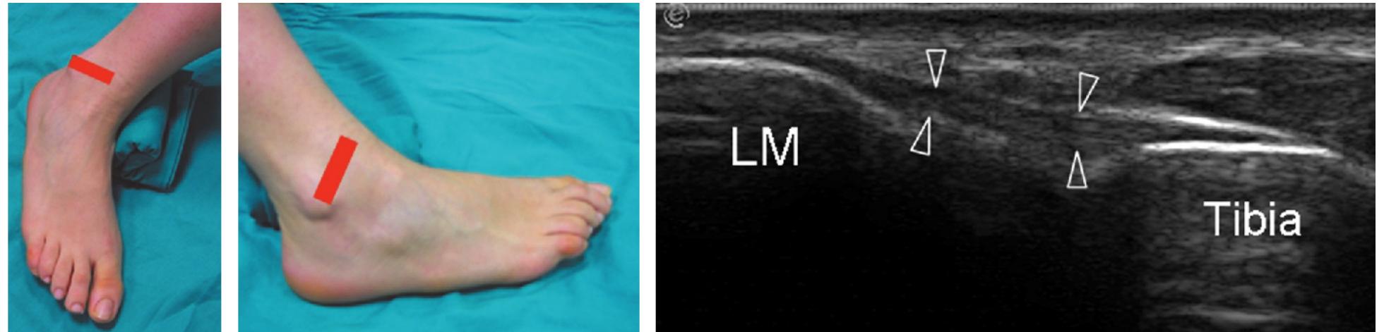Legend arrowheads anterior tibiofibular ligament; lm lateral
