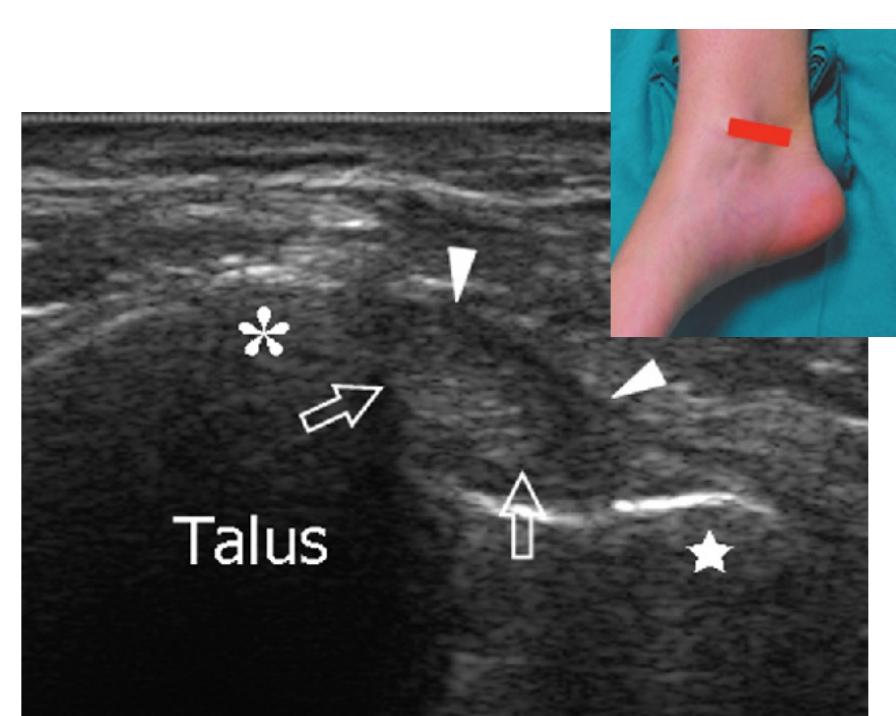 10. flexor hallucis longus tendon (short-axis: