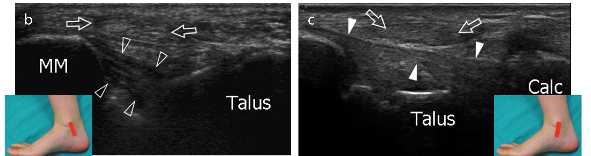 Legend b, c arrows, posterior tibial tendon; mm medial