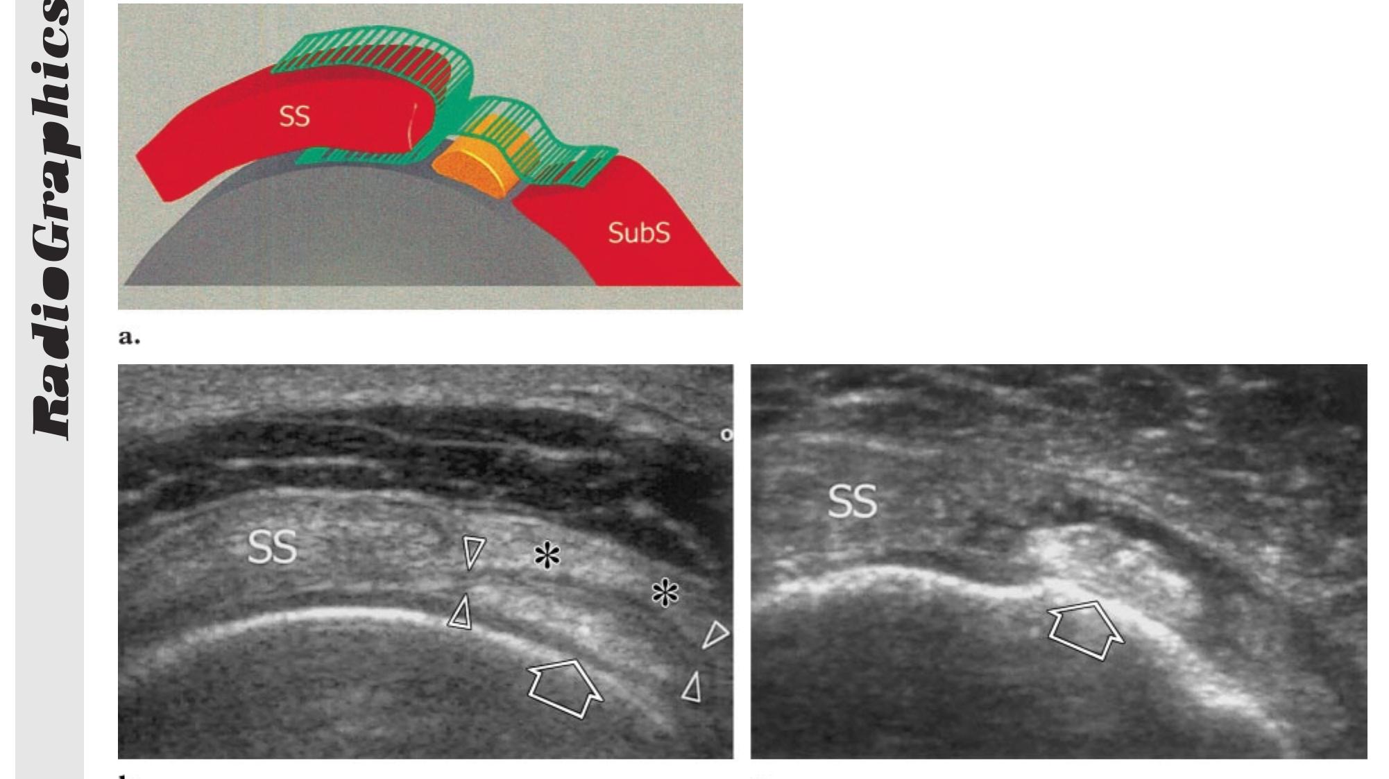 Rotator cuff interval. (a) schematic illustrates the