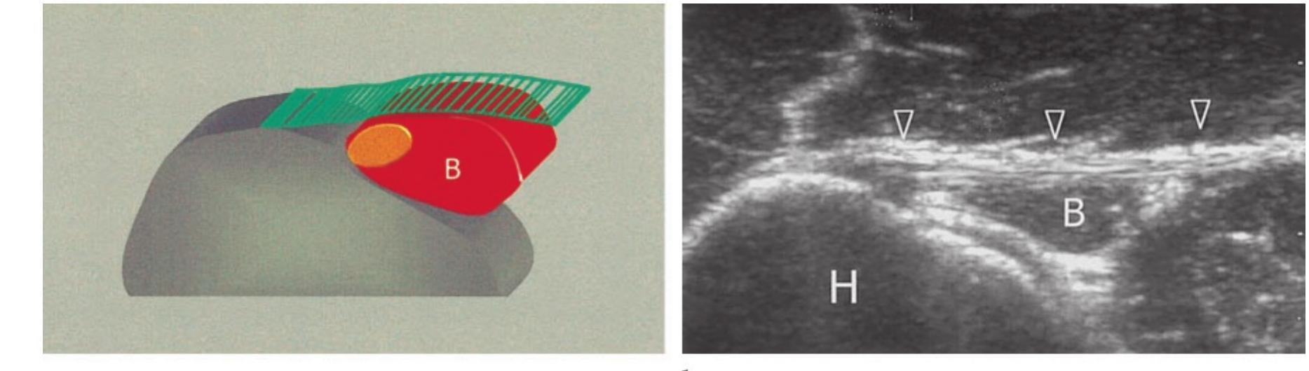 Pectoralis major tendon. (a) schematic illustrates the