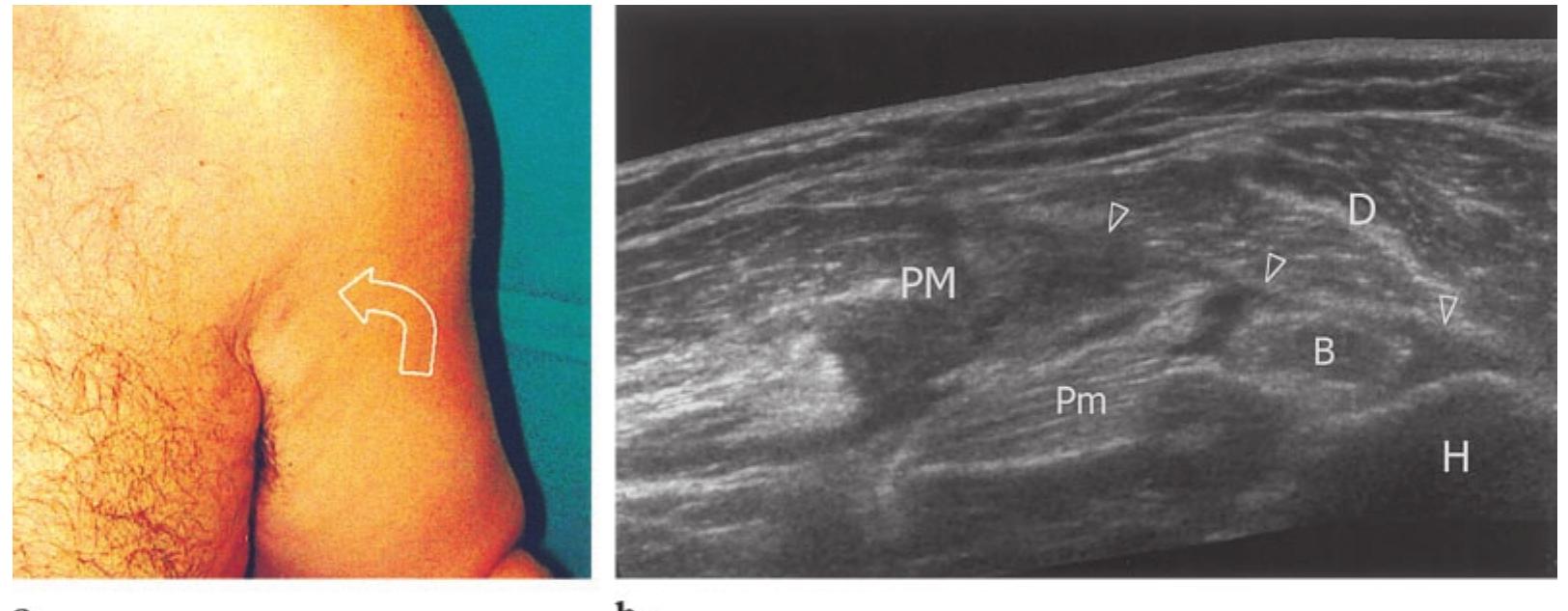 Pectoralis major tendon tear in a 37-year-old man who
