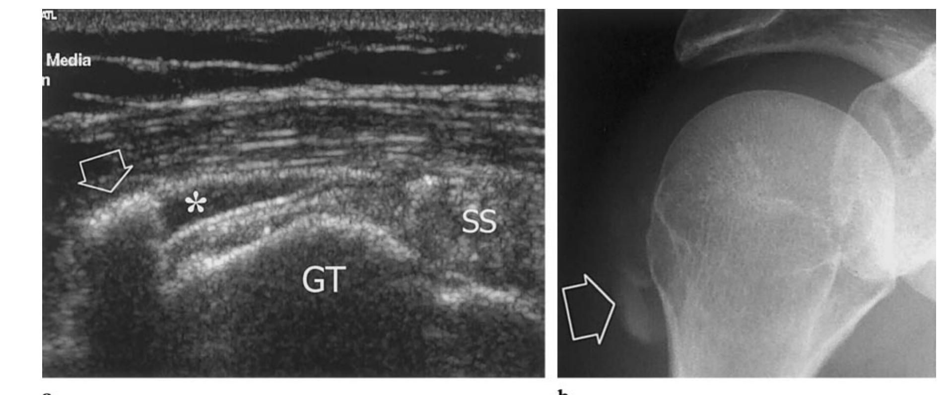 Intrabursal rupture of calcifying tendinitis in a
