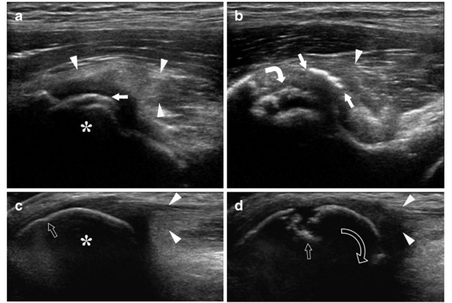 Apophyseal injuries. a, b avulsion injury of the anterior