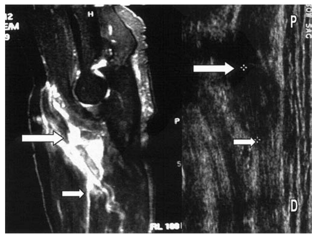Torn distal biceps tendon. longitudinal ultrasound image