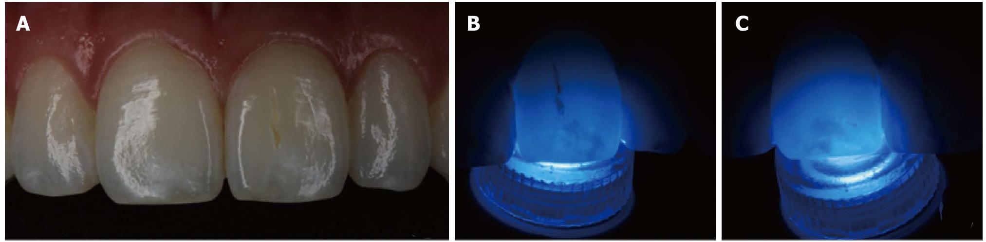 Transillumination to determine staining depth. a: enamel