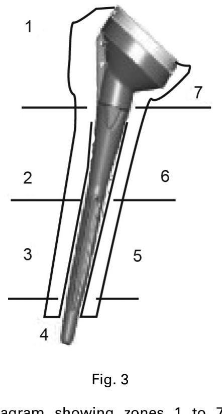 Results scapular notch. a scapular notch was observed in 60