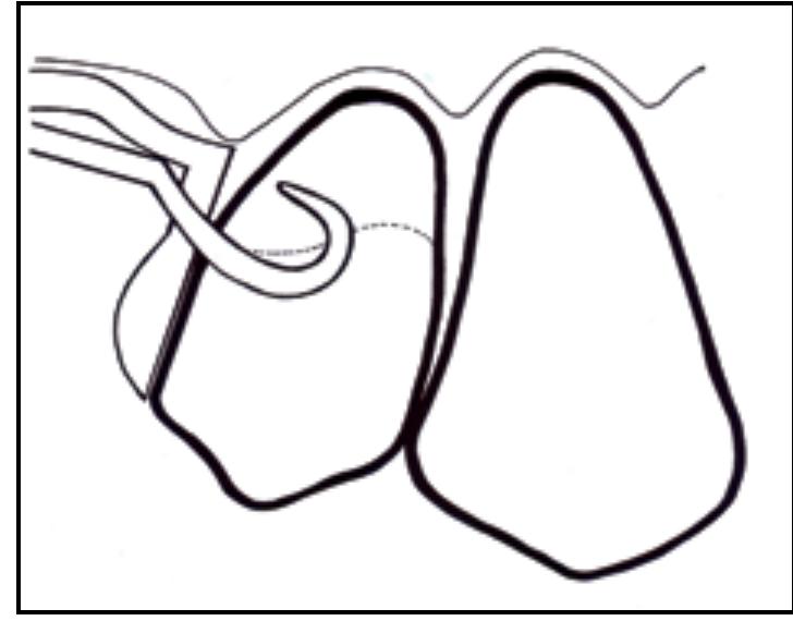 Schematic illustration of the back-action clasp. the distal