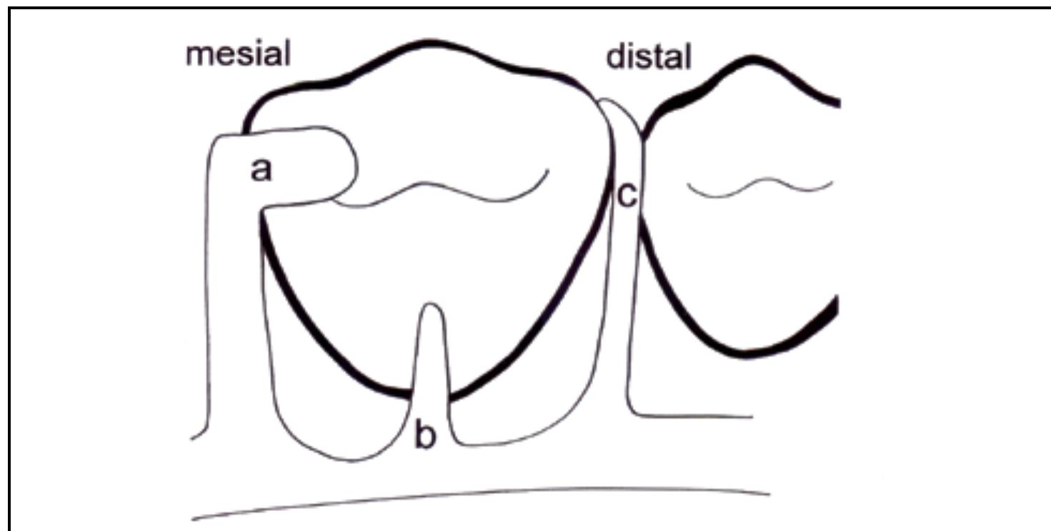 Palatal/ lingual | bar. schematic illustration of the clasp