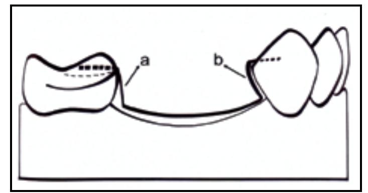 B. rpd rotated in position. no anterior clasp. a = minor