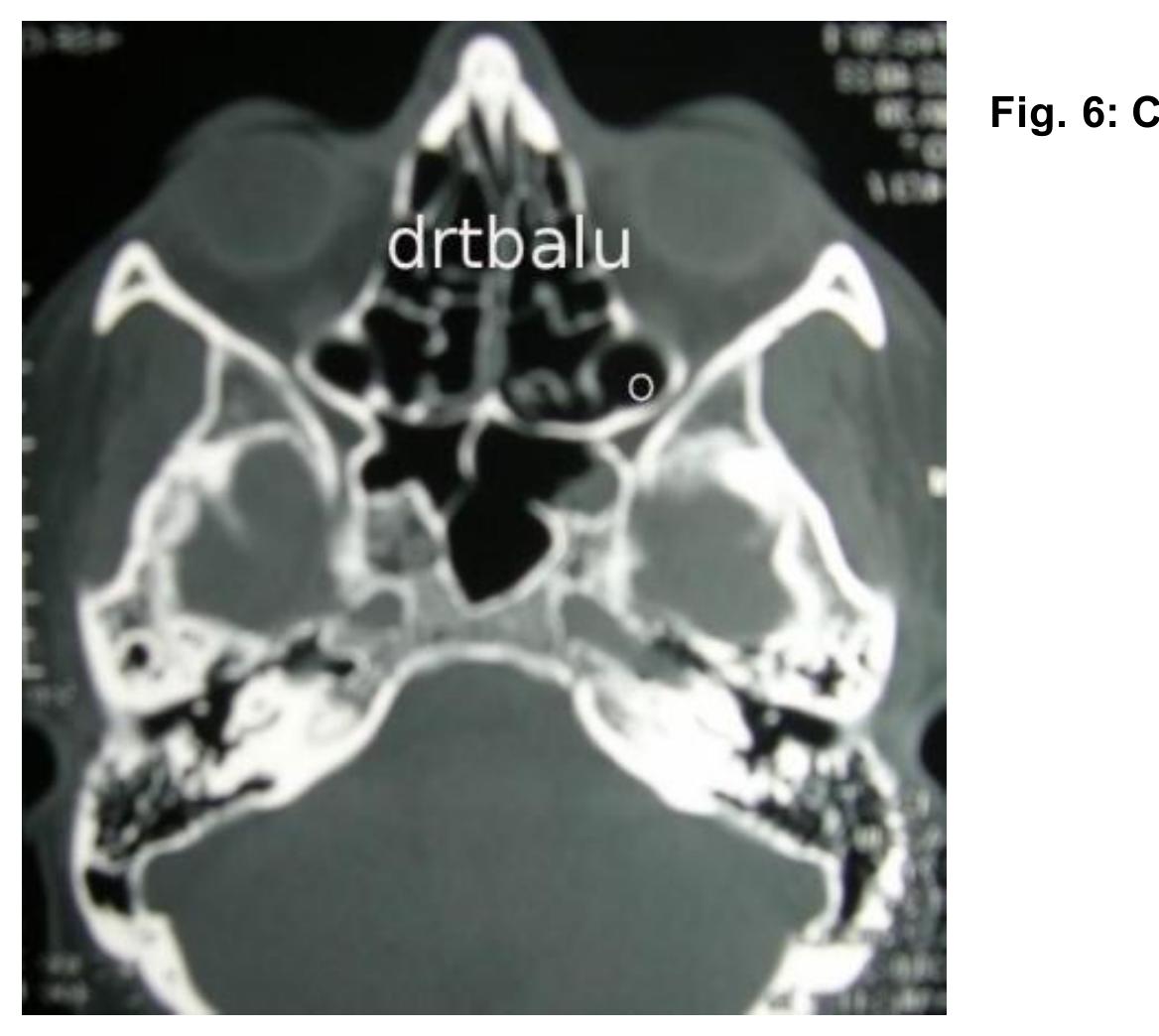 Figure 3 - from Anatomy of Paranasal sinuses