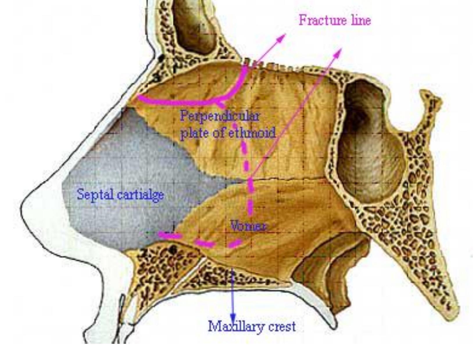 Figure 2 - Fracture Nasal bone and its management