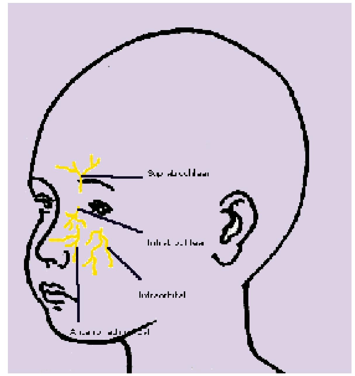Figure 5 - Fracture Nasal bone and its management