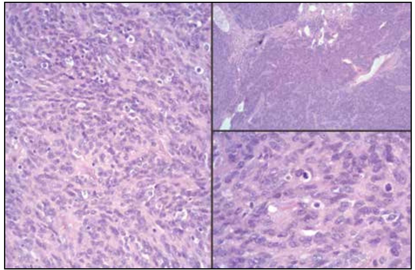 follicular dendritic cell sarcoma. this spindle cell