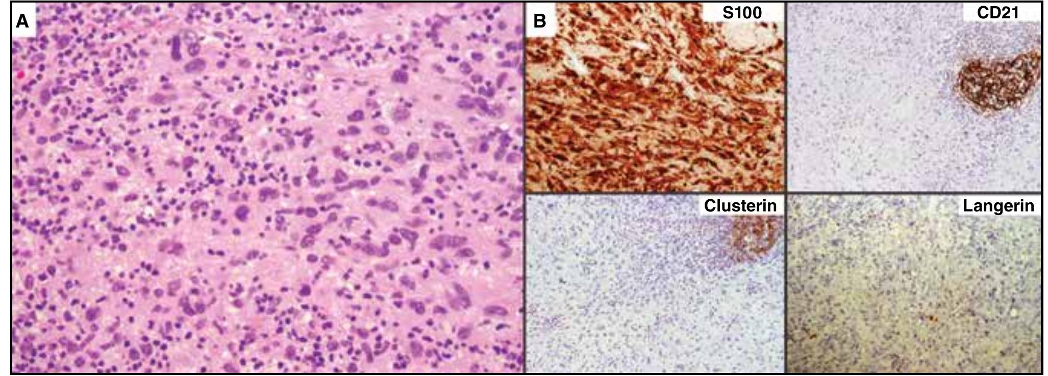 interdigitating dendritic cell sarcoma. (a) paracortical