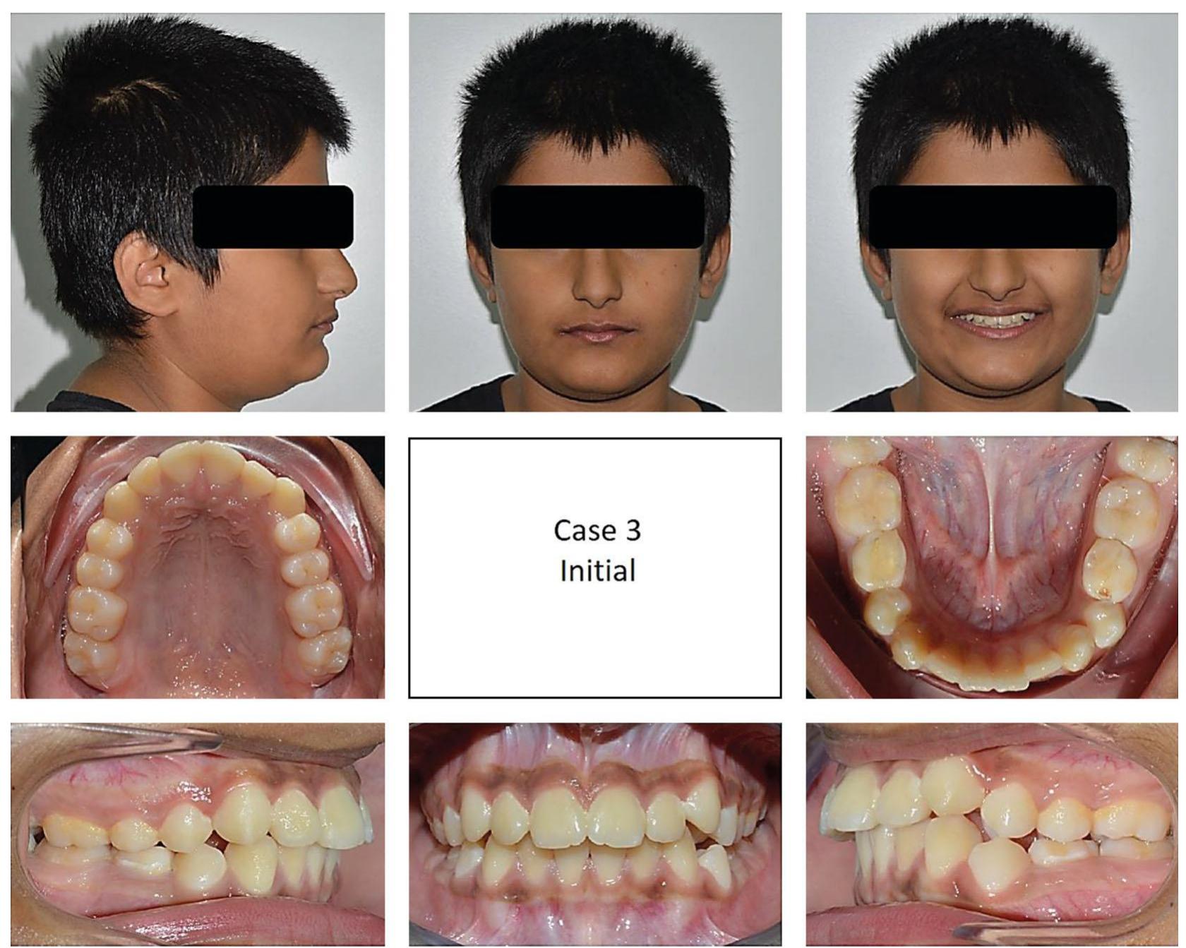 Pretreatment extraoral and intraoral photographs of the