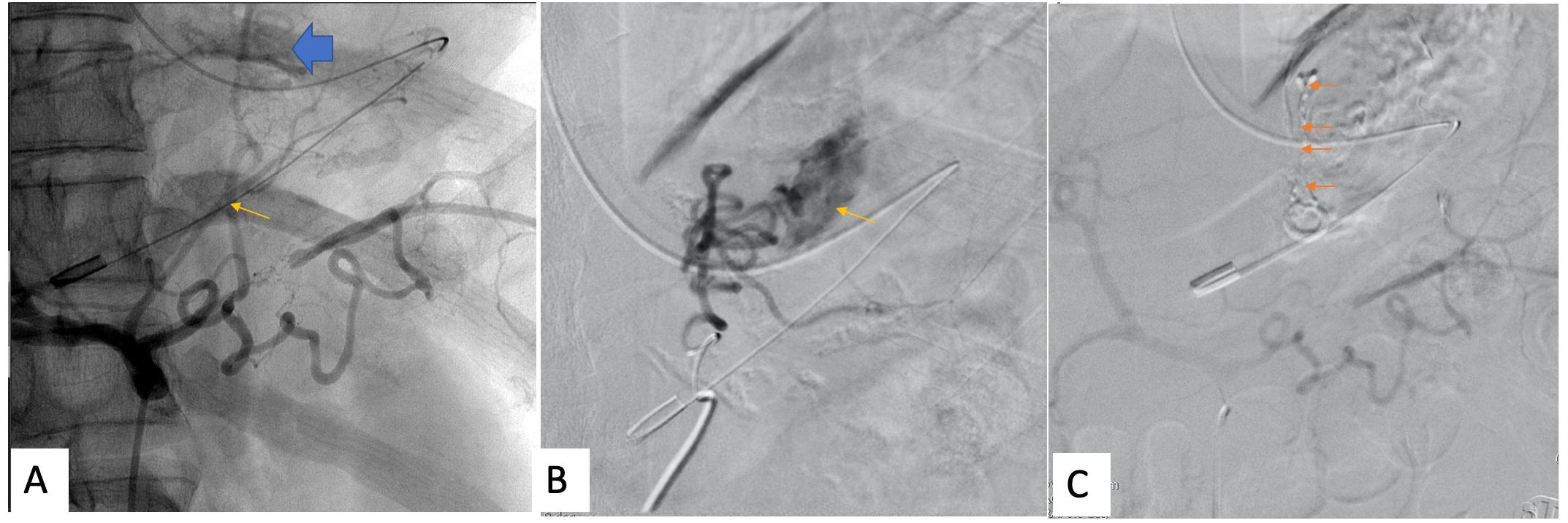Coeliac angiogram (a) showing a tortuous vessel from the
