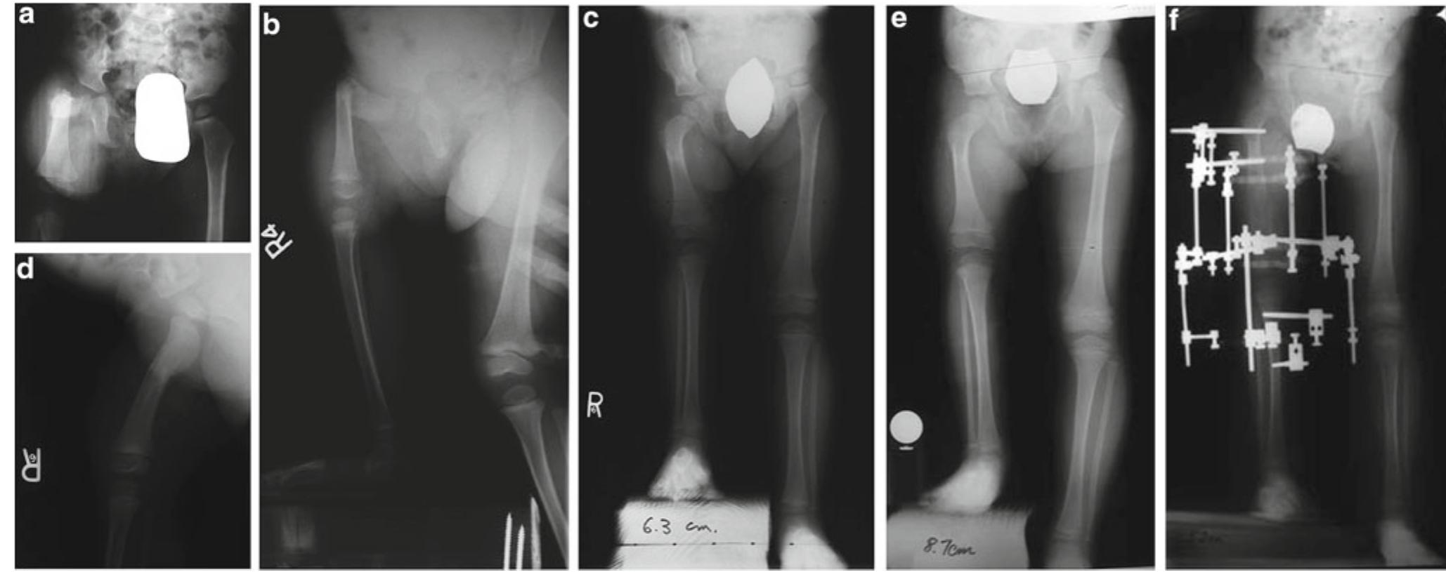 17 two-year-old girl born with paley type 1b subtrochanteric