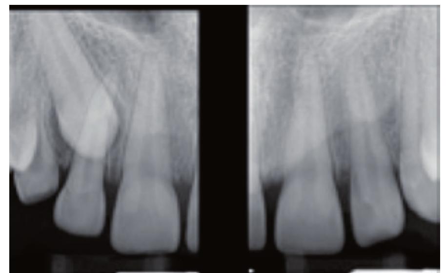 15-year old boy with palatally impacted maxillary right