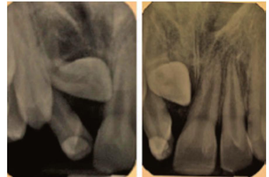 B. periapical view fig. 3. 12-year old boy with 2 buccally