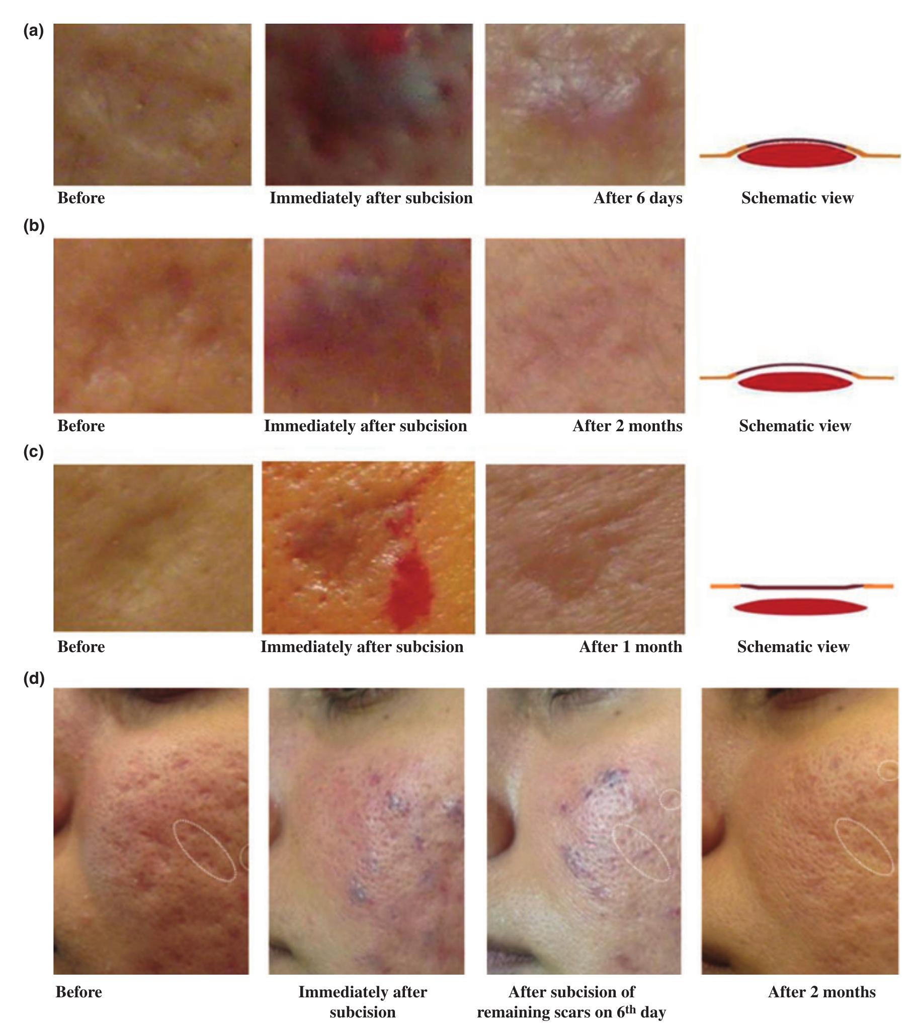 Performing subcision precisely is essential to have good