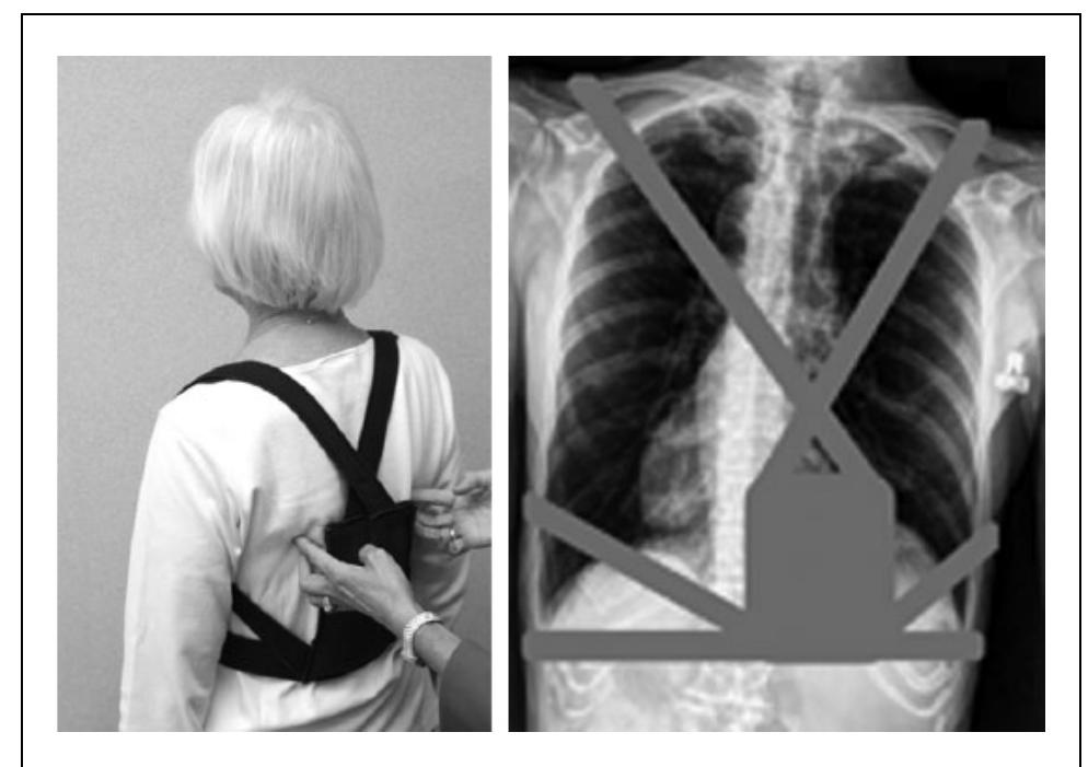 I. left: weighted kypho-orthosis positioning for kyphosis.