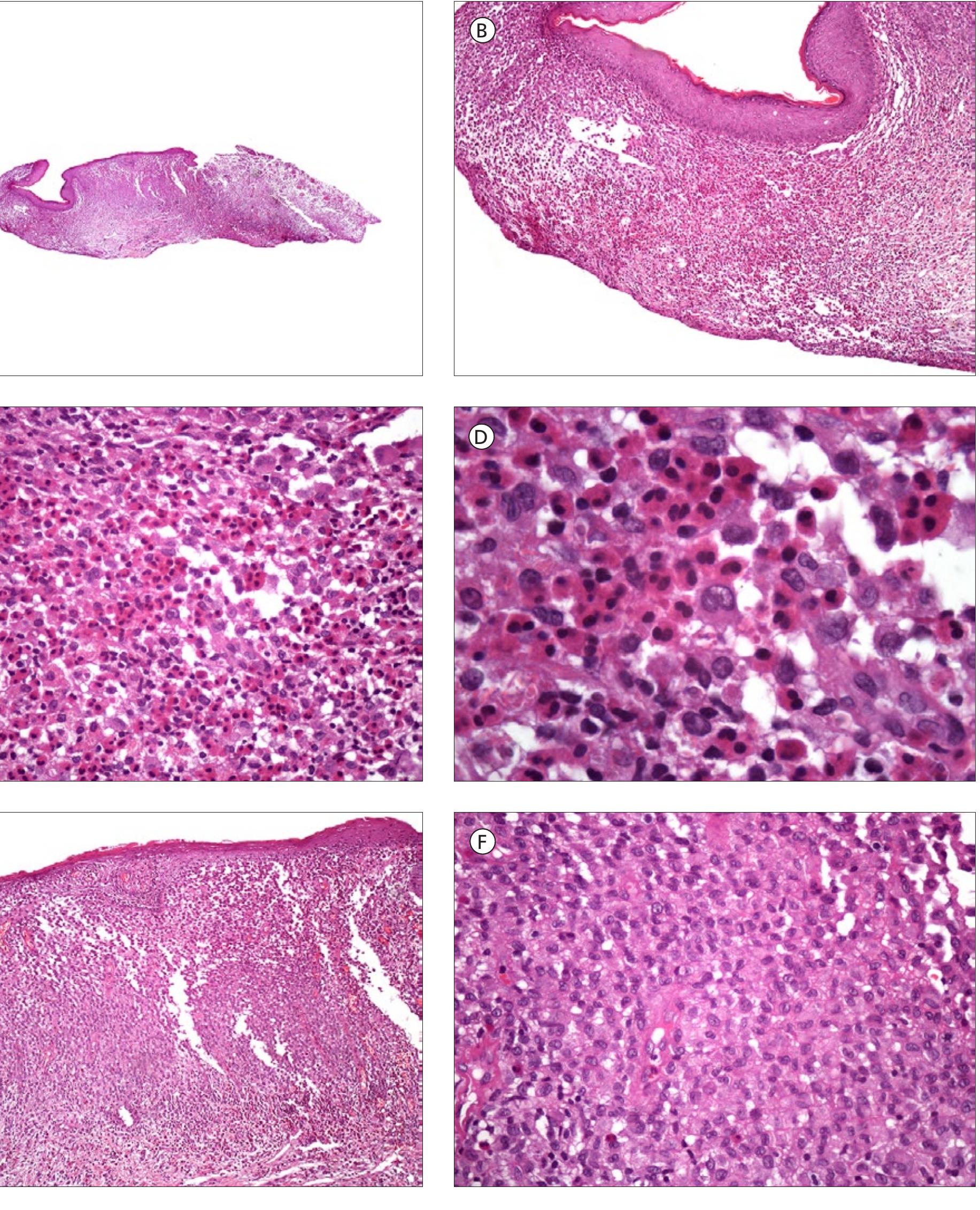 (a) langerhans cell histiocytosis, perineal lesion, scanning