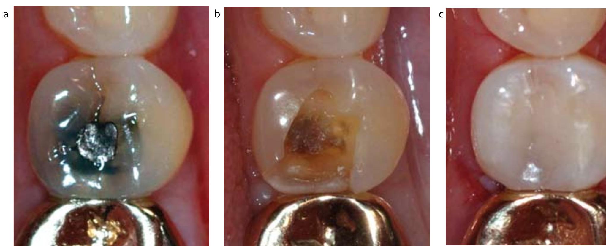 (a—c) disto-occlusal restoration of a lower premolar in