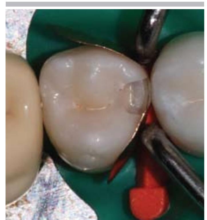 Forceps to flex open and apply a separation ring (g-ring,