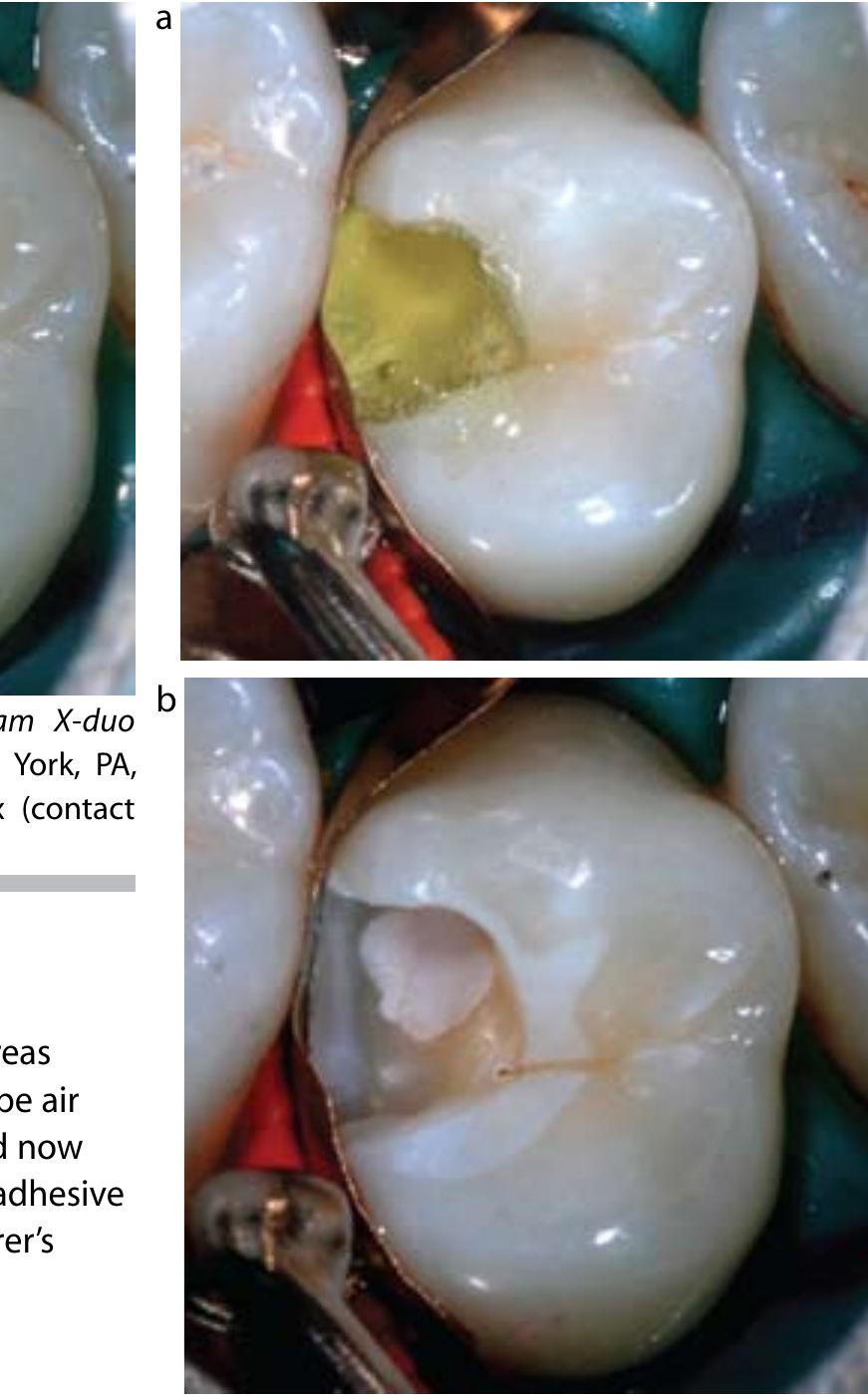 (a, b) total etch of disto-occlusal premolar cavity (and