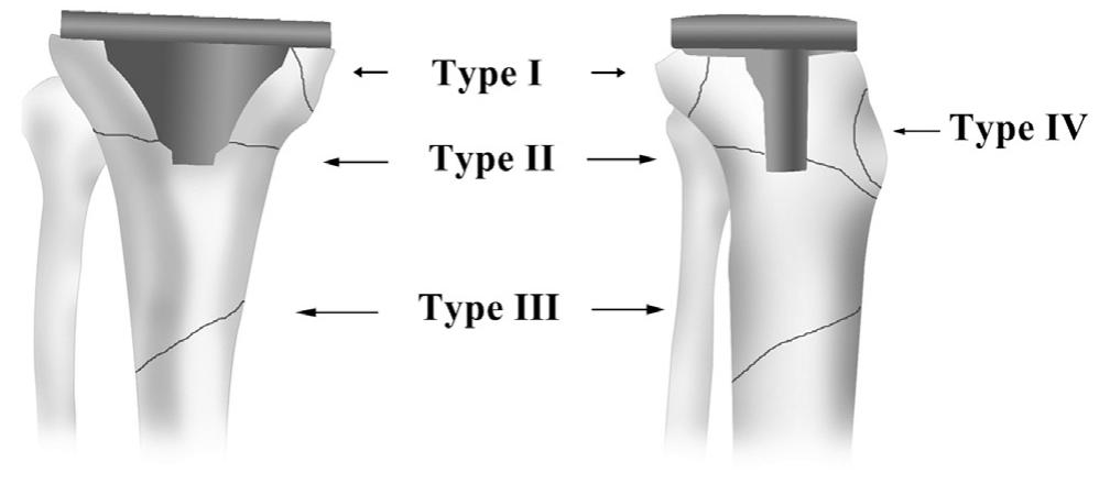 Classification of periprosthetic tibial fractures described