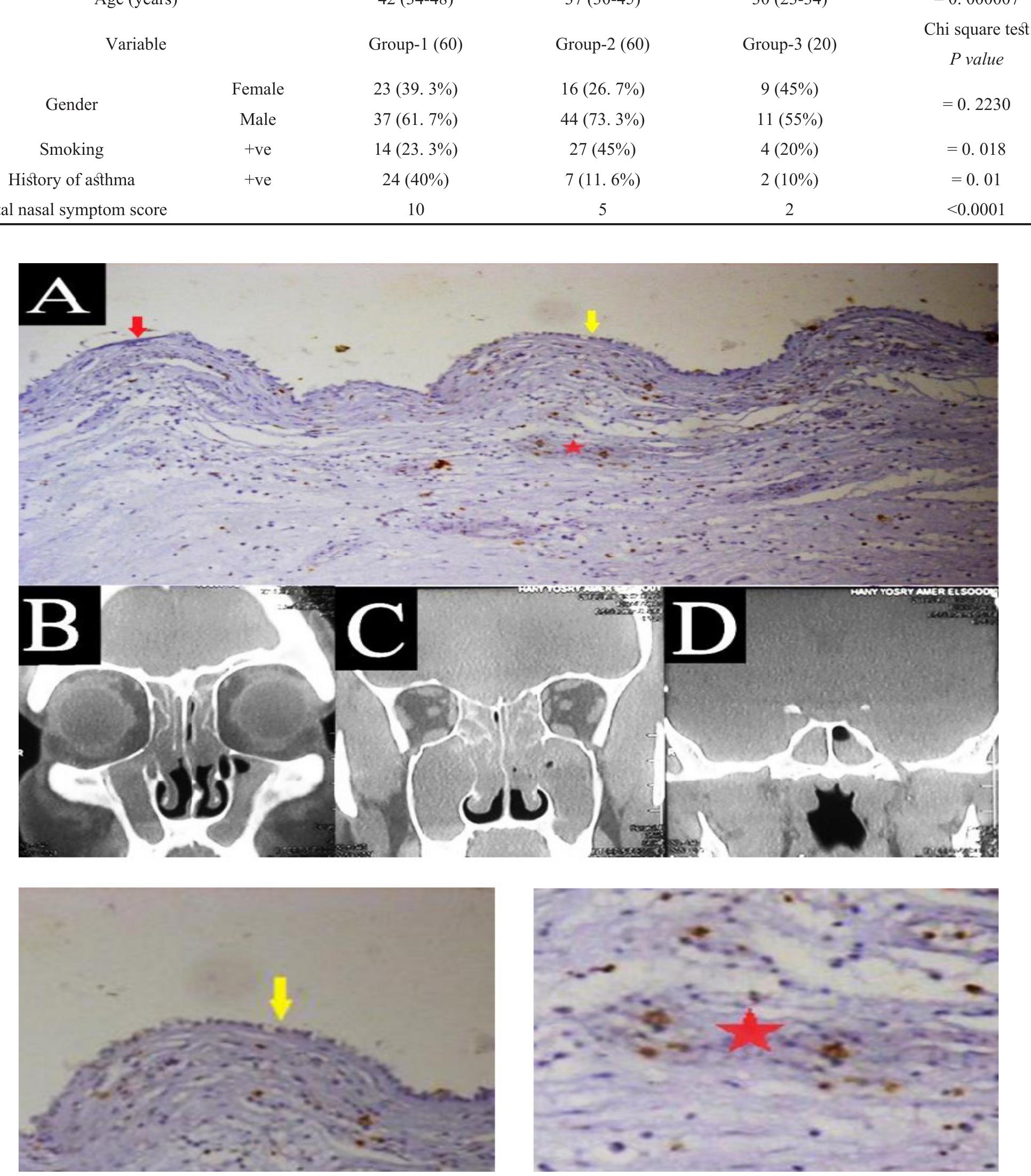 (a) case of chronic rhinosinusitis with nasal polyp (a) the