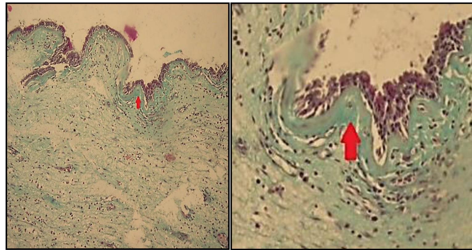 A case of chronic sinusitis with nasal polyp, ethmoidal