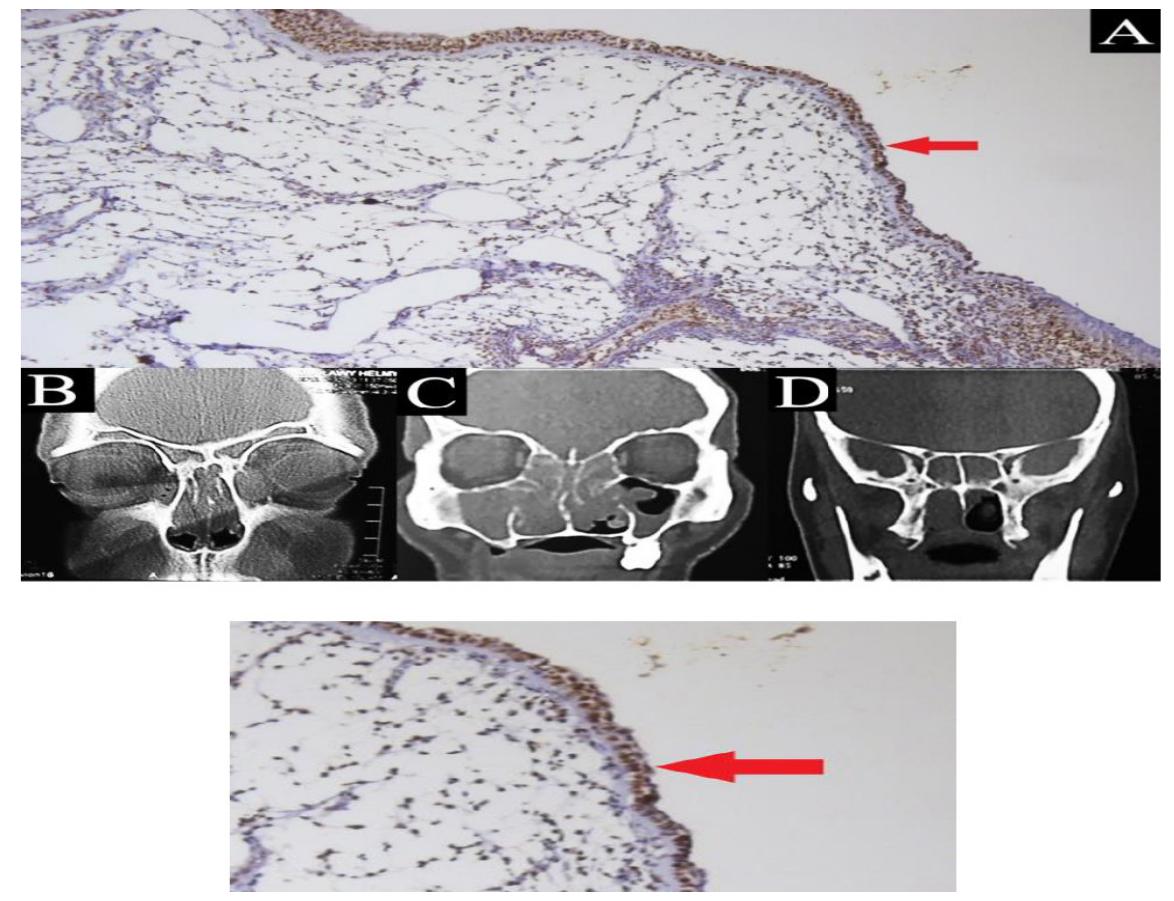 A case of chronic rhinosinusitis with nasal polyps (a) the