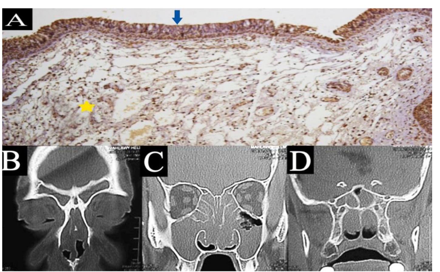A case of chronic sinusitis with nasal polyps (a) the
