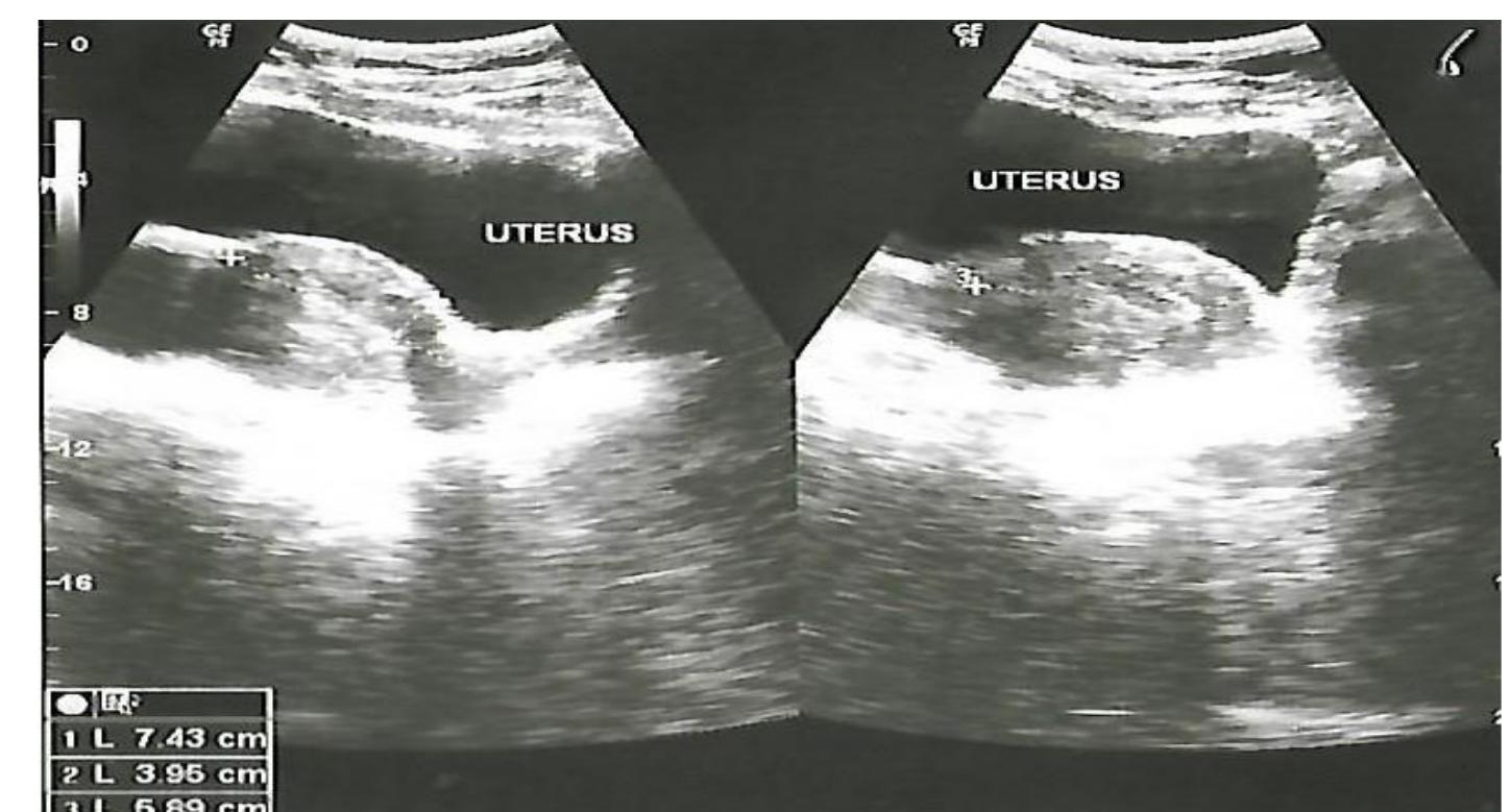 - 2: a fibroid at posterior wall of uterus fig- 3: showing