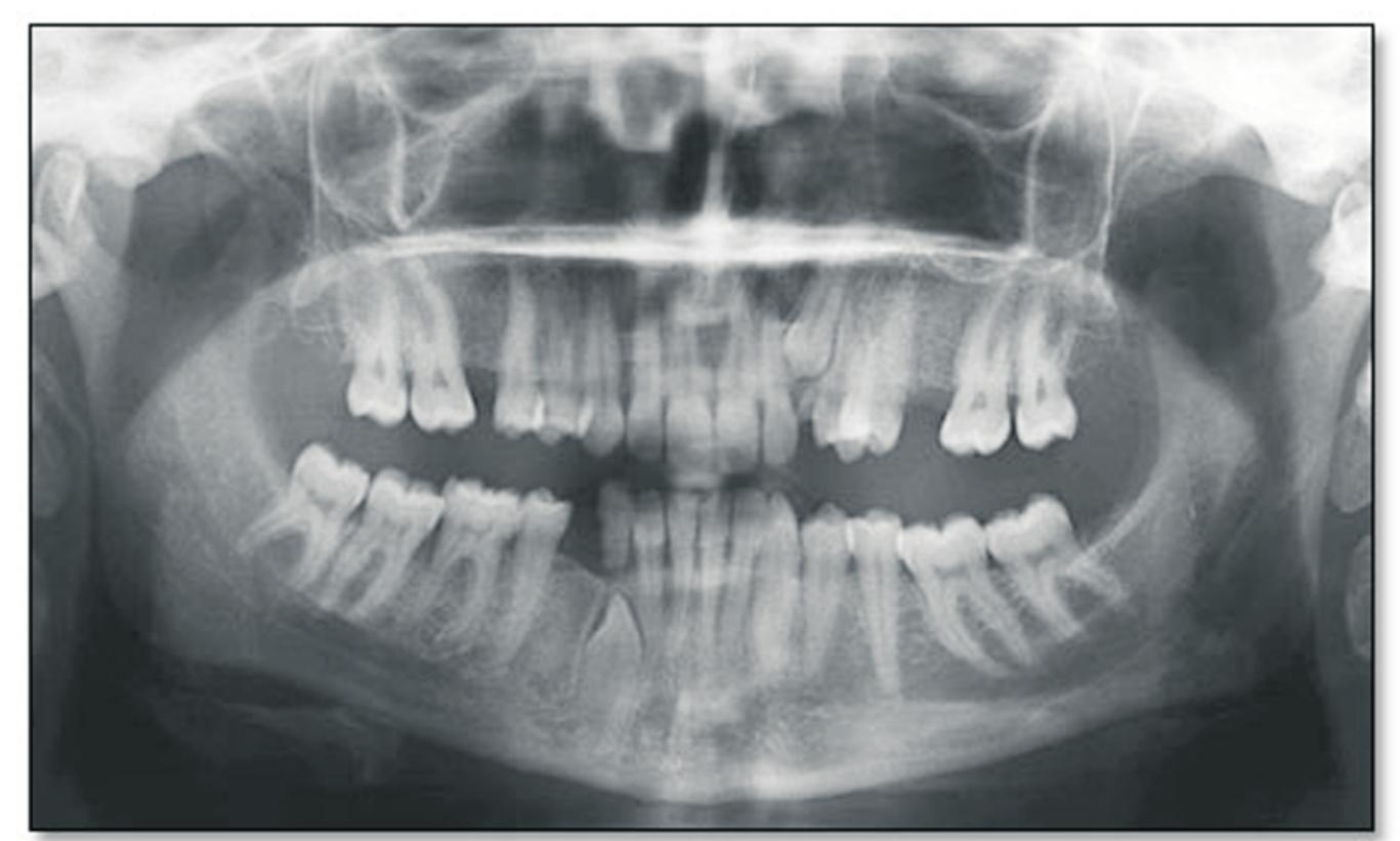 A vertically impacted mandibular canine tooth and primary