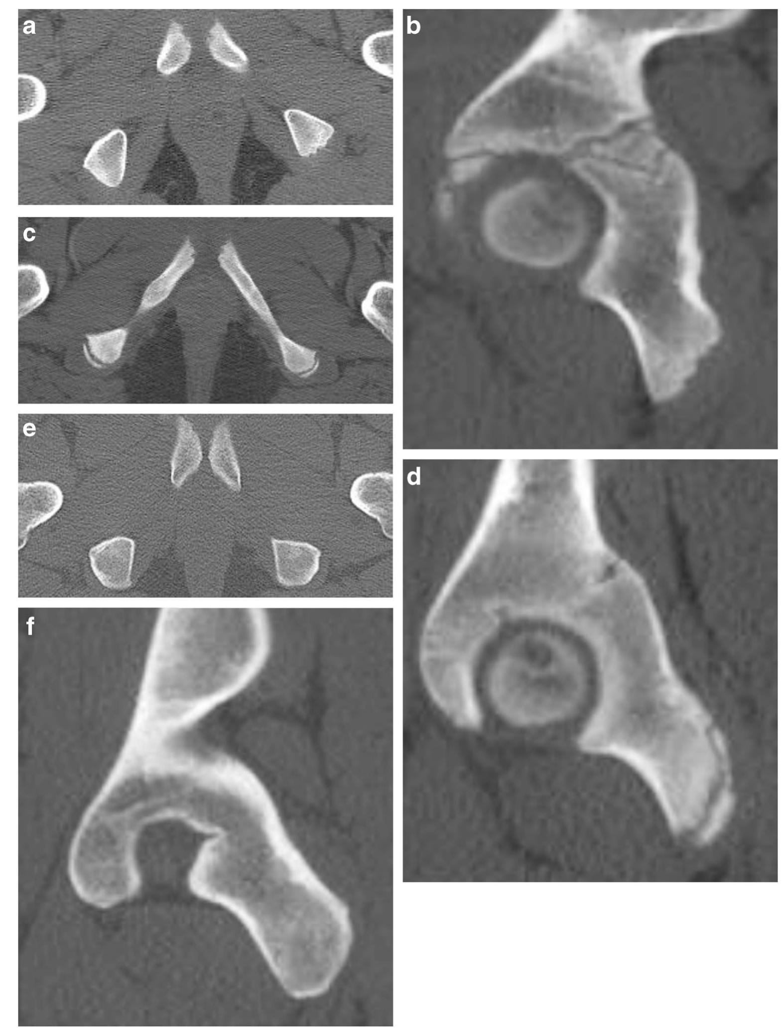 Symphysis pubis, sacrum and iliac crest apophysis ossifi-