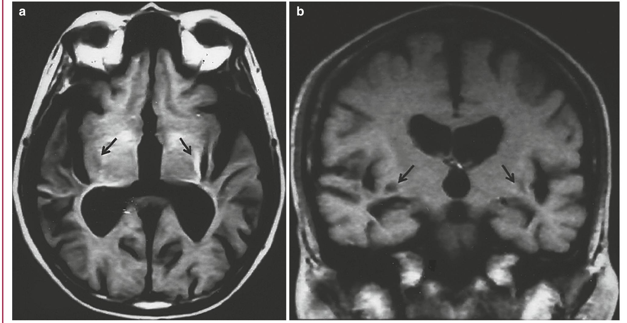 15 auditory agnosia caused by bilateral lesions restricted