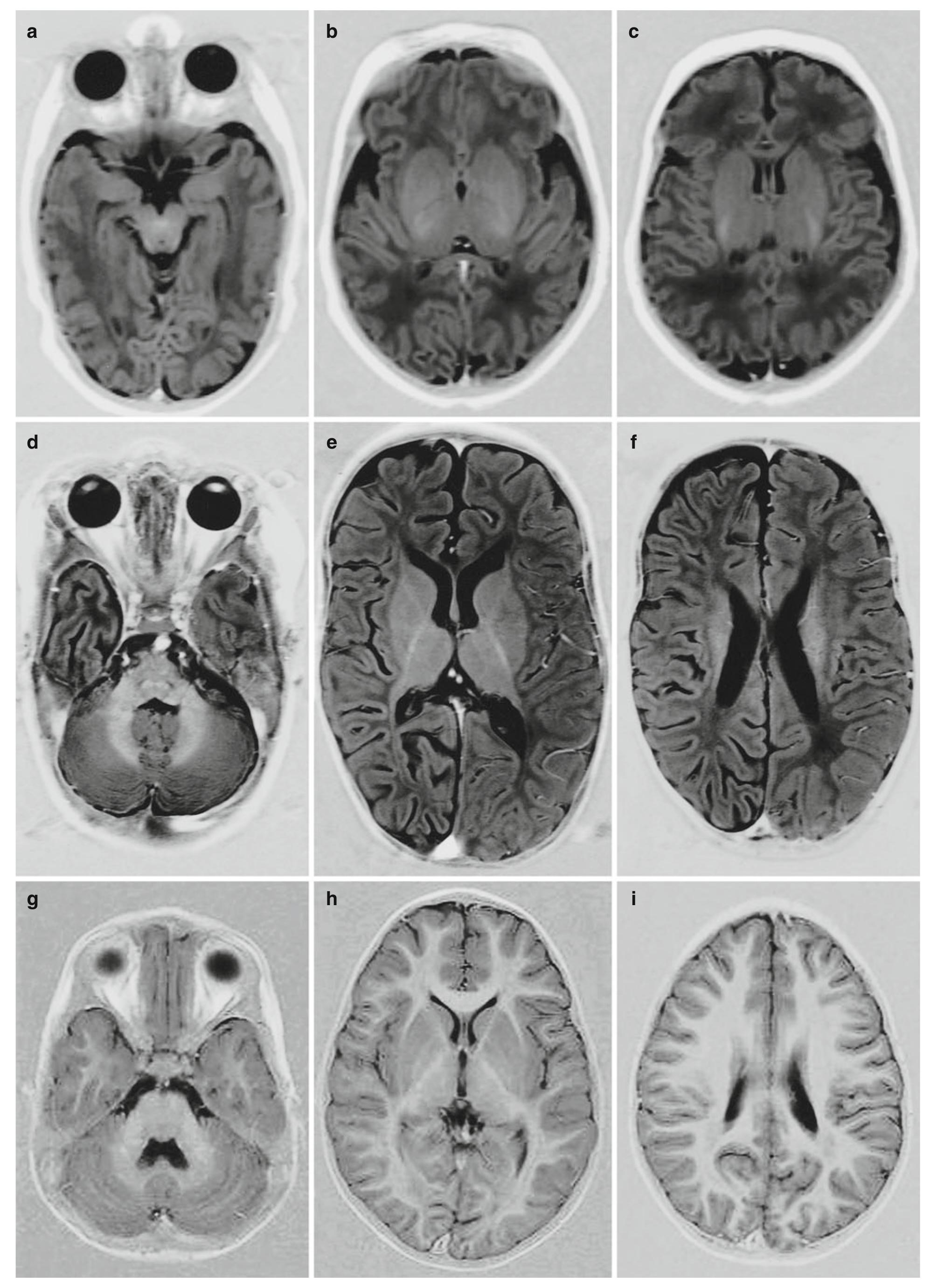 39 myelination in t1-weighted horizontal (or axial) images
