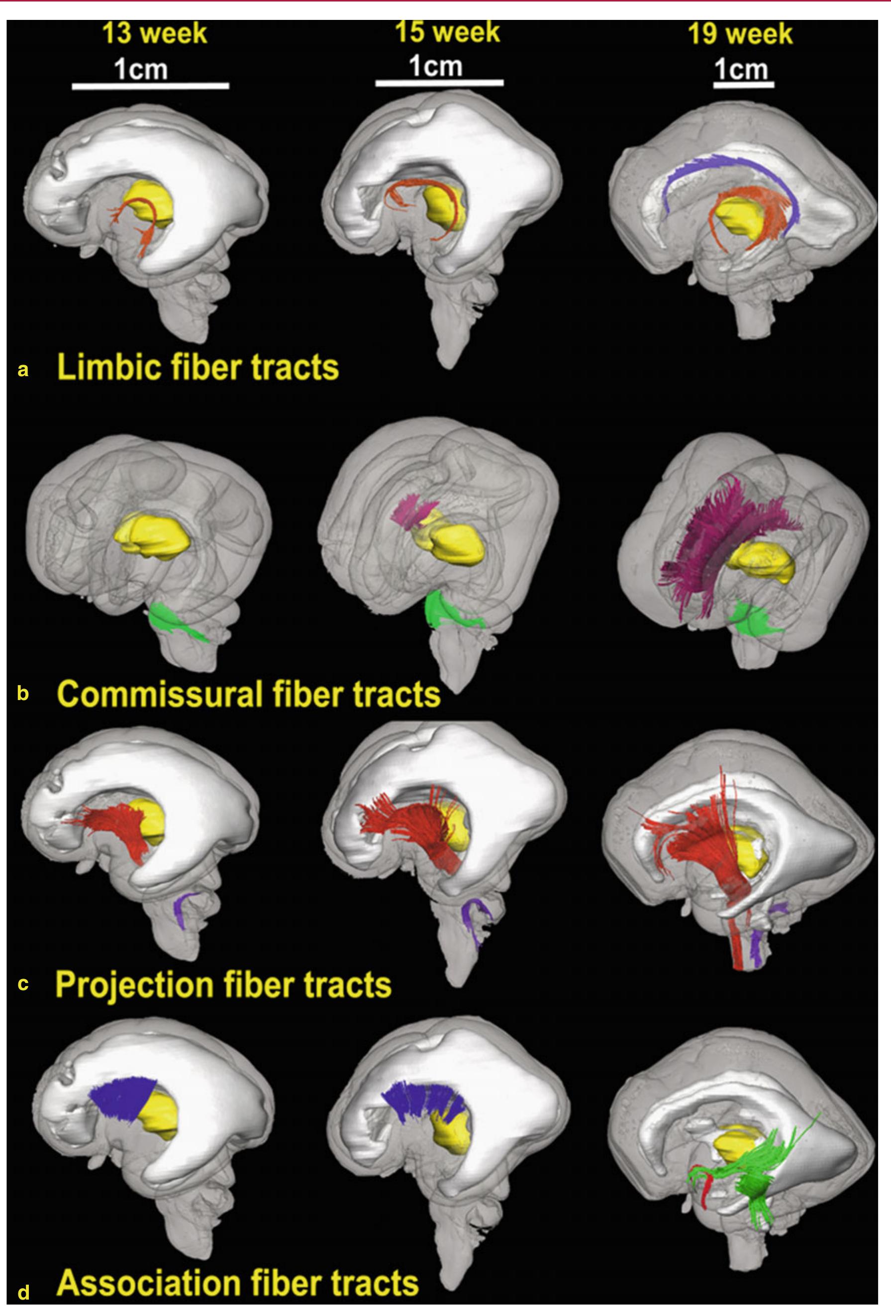 Inferior cerebellar peduncle in purple; (d) lateral views of