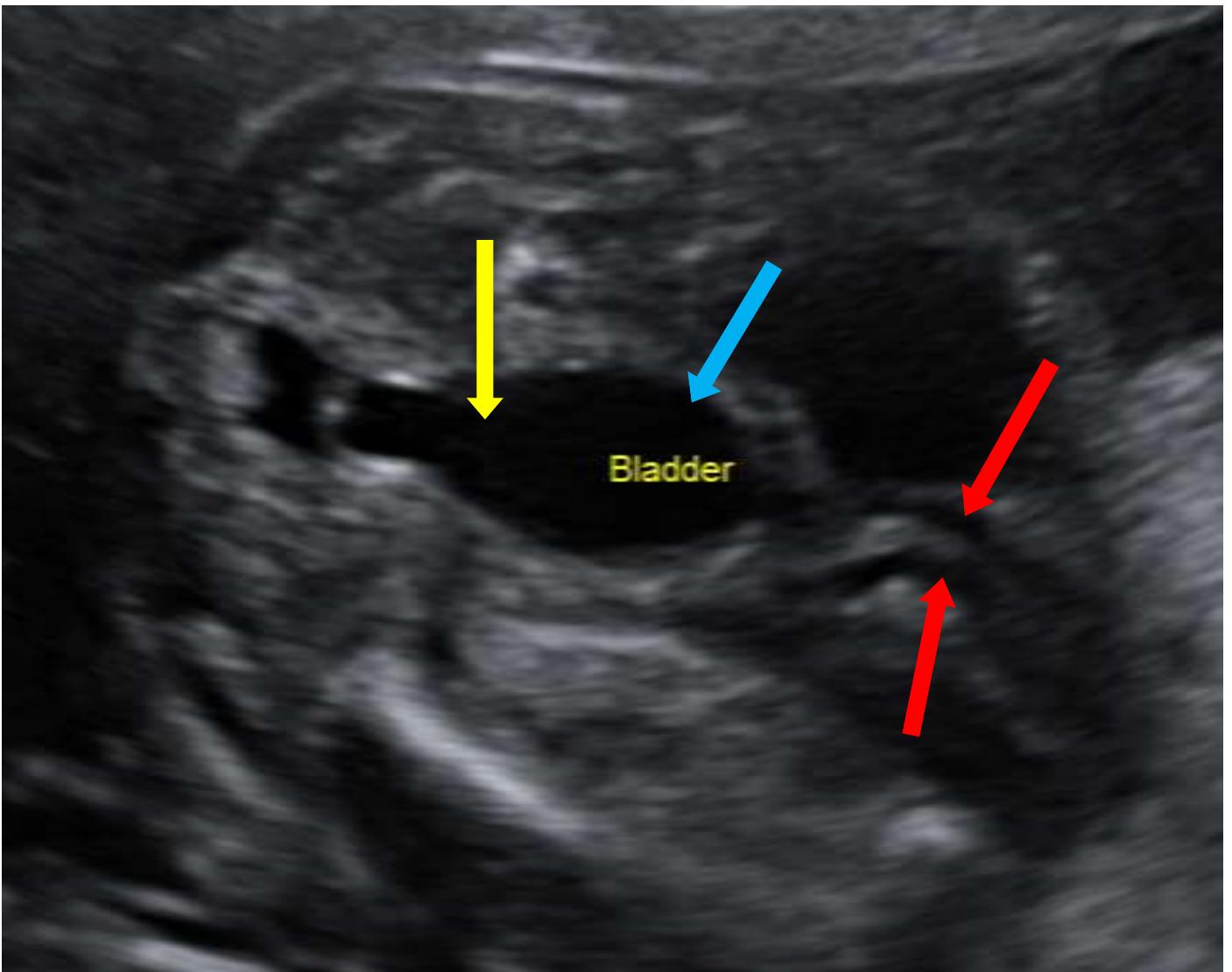 Figure 6 - Fetal Ascites and Posterior Urethral Valves. A