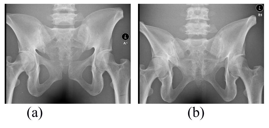 Radiographs of the sacrum bone (a) ap projections, (b) axial